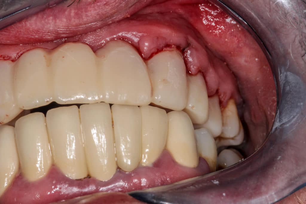 Gingivitis vs Periodontitis: What's the Difference?